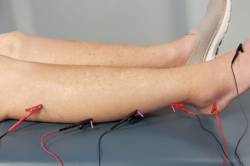 Safe, Affordable Dry Needling in Las Vegas | DynamicSpineSport