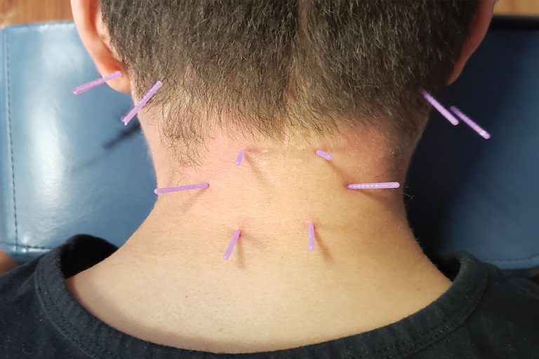 Safe, Affordable Dry Needling in Las Vegas | DynamicSpineSport